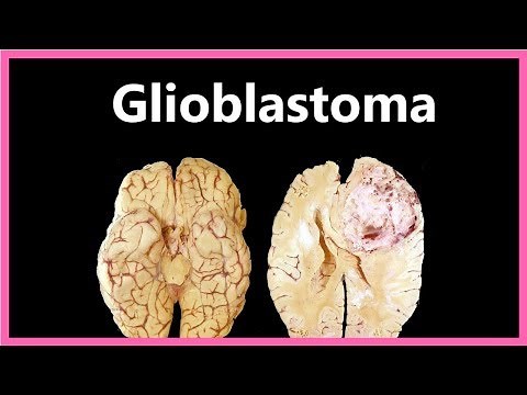 Glioblastoma Multiforme – Symptoms, Diagnosis and Treatment ✔
