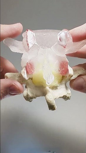A small bridge of bone remaining in this spondylolytic model by Dynamic Disc Designs