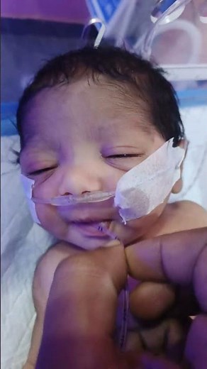 How NG Tube is Inserted in a Newborn Baby 👶💉 | NICU Nurse Care #NewbornCare #NGTubeInsertion