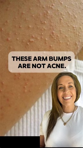 Those tiny bumps on the backs of your arms aren’t acne. They’re keratosis pilaris, a harmless buildup of keratin that forms a little plug at the opening of the follicle. It often worsens when the skin is dry or the barrier is a bit reactive, which makes the texture feel rough and look red. Gentle care, hydration, and consistency make the biggest difference over time. #keratosispilaris #skinscienceexplained | Flora Lane Skin