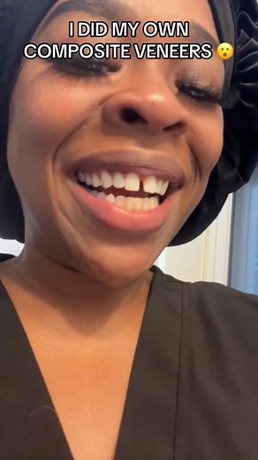 DIY Composite Veneers Gone Wrong - Risky Dental Procedure
