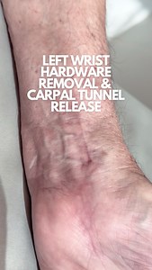 This patient originally underwent a left distal radius open reduction internal fixation in which plates and screws were drilled into the distal radius by an outside physician. The patient agreed that a hardware removal was the best option after having issues with the screws, along with a carpal tunnel release. He was extremely concerned when he initially saw me because of the poor fixation by the first surgeon. He is doing great and happy to have a functional and painless wrist! #drcohen #drcohe