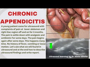 Ultrasound of appendix | chronic appendicitis | appendix symptoms | appendix ultrasound report