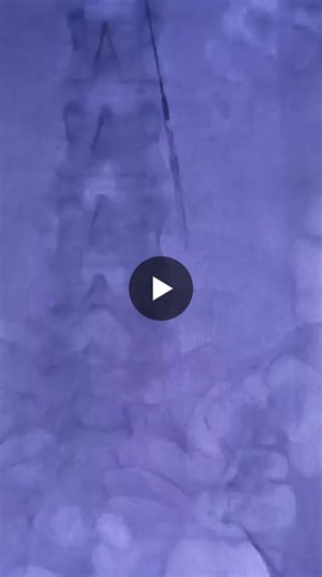 #vascularintervention #peripheralvascular #ivcfilter #fluoroscopicvisibility #clinicalinnovation #cedimat #americas #zyloxtonbridge #strategicpartnerships | Antonio de los Santos