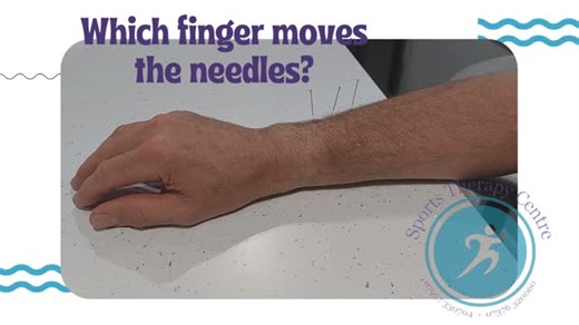 Sports Therapy Centre on Instagram: "✨ Dry Needling in Action ✨ Ever wondered how precise dry needling really is? In this video, you’ll see needles placed into specific muscles in the arm. As each finger moves, only the needles connected to the muscles responsible for that movement respond. This shows just how targeted dry needling is — we’re not working randomly, we’re treating the exact muscles involved in your pain or restriction. Dry needling helps release tight muscle fibres, reduce pain, i
