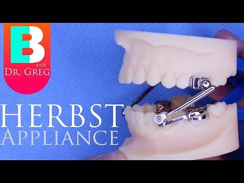 [BRACES EXPLAINED] Herbst Appliance