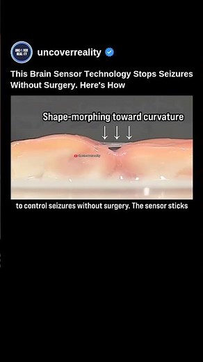 This Smart Brain Sensor Technology Stops Seizures Without Surgery. Here's How #brain #tech #shorts