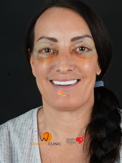 Let us give you the splendid smile you've always wanted, you deserve it! 1) VIP pick-ups and drives between the airport, hotel & clinic. 2) Translator and medical consultant with you at all times in our clinic. 3) Guarantee on the results of your dreams. Contact us to get your free consultation 🤗 📞 ⁦ 90 544 792 46 66⁩ https://wa.me/905447924666 📍Istabul, Turkiye. . . . . . . . . . . . #Gravity #Turkey #Istanbul #dentaltourismturkey #dentalclinicturkey