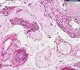 Histopathology Testis --Atrophy
