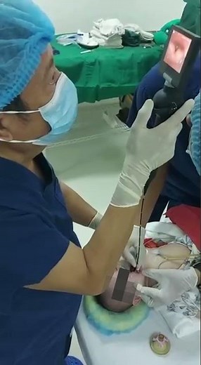 Infant Intubation | Flexible Video Laryngoscope Demonstration by Doctor #medical #intubation
