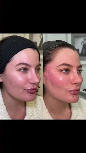 PDO Thread Lift: Your Non-Surgical Facelift Solution! 💫