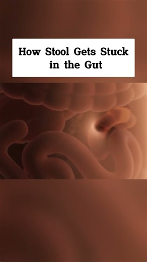 How stool Gets Stuck in the Gut | Gut Health | Anatomy 3D Lab UK