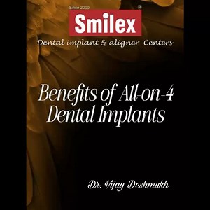 Benefits of All-on-4 Dental Implants