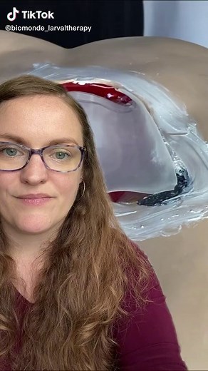 Effective Tips for Using Larval Therapy on Pressure Ulcers