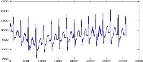 Figure 1 From Wavelet Transform Based Analysis Of QRS Complex In ECG