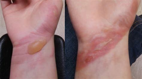Difference Between St Nd And Rd Degree Burns