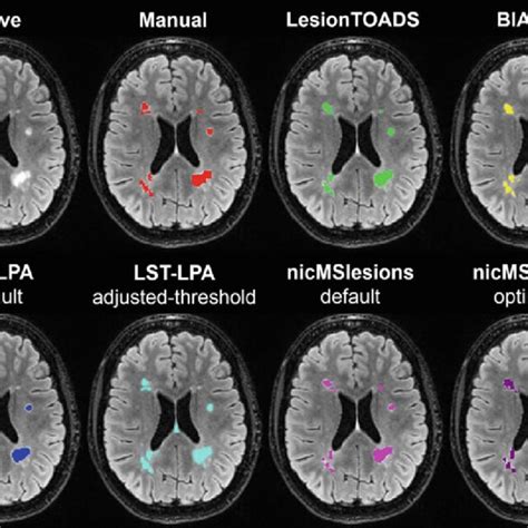 output examples of four lesion segmentation algorithms and manual download scientific diagram
