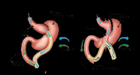 Roux En Y Gastric Bypass In Turkey Costs And Surgery
