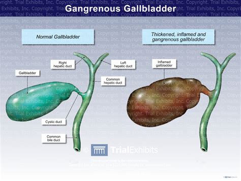 Gangrenous Gallbladder TrialQuest Inc