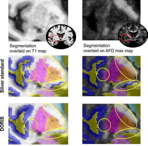 frontiers doris a diffusion mri based 10 tissue class deep learning segmentation algorithm