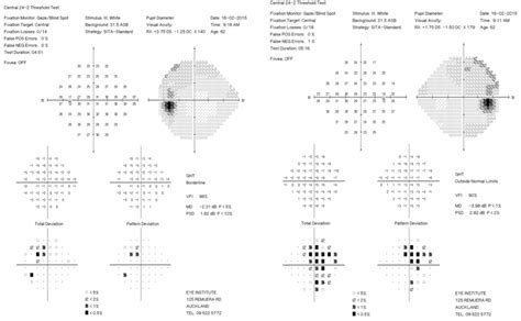 question 2 what is your assessment of the visual fields glaucoma professional education