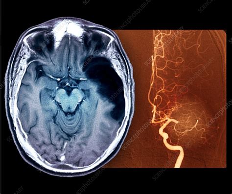 Stroke MRI Brain Scan Stock Image C048 0716 Science Photo Library
