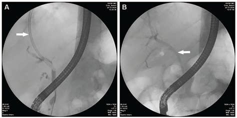 Ercp Stent