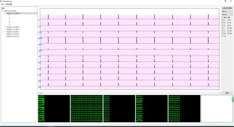 qt开发之心电显示项目实现 qcustomplot 心电图 csdn博客