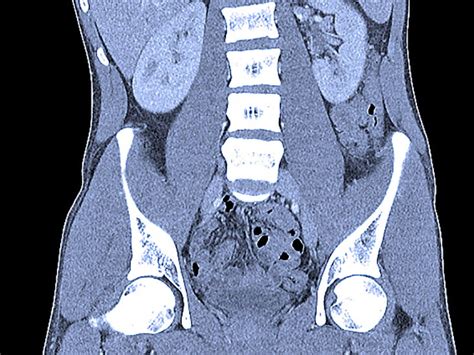 Normal Ct Scan Abdomen
