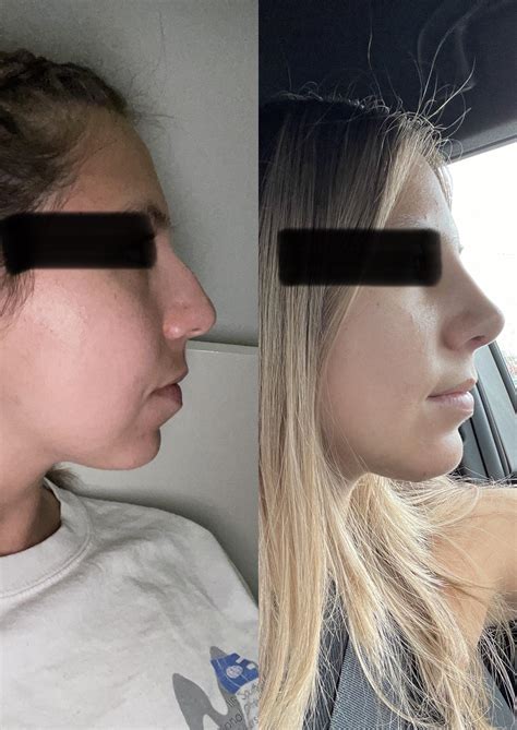 Beforeafter 7 Day Post Op Cast Removal Day Rhinoplasty And Chin Augmentation Rplasticsurgery