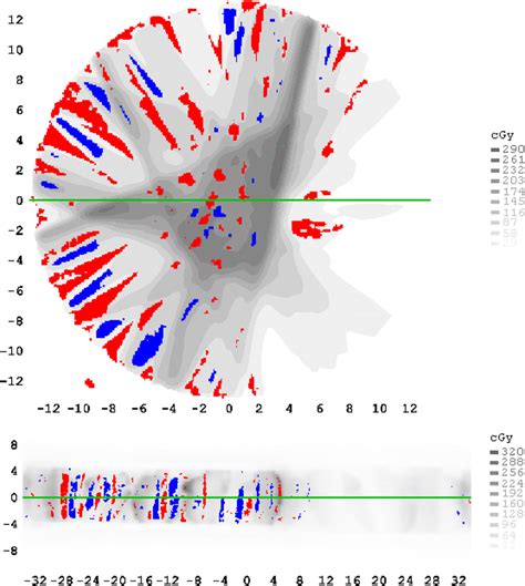 dose map calculated in iplan rt dose with the monte carlo algorithm for download scientific
