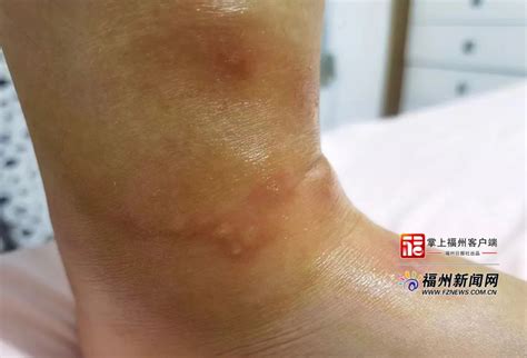 被红火蚁咬伤怎么办医生解答 福州 新闻频道 福州新闻网