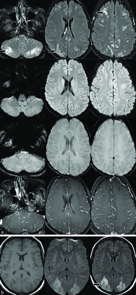 A FLAIR DWI SWI And T1W Contrast Axial MRI Brain Sequences Of A