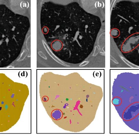 pdf detection of lung nodules using unsupervised machine learning method