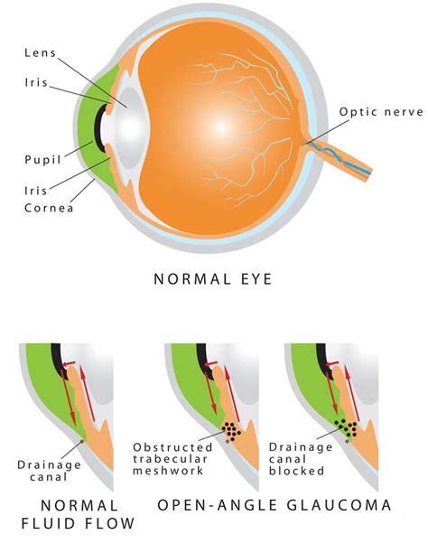types of glaucoma glaucoma associates of texas