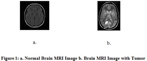 a hybrid method for brain tumor detection using advanced textural feature extraction