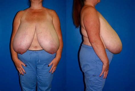 Saggy Tits Breast Reduction 021 40 Pics XHamster