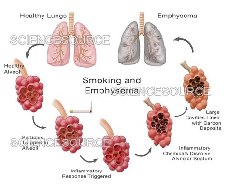 Emphysema Lung Vs Normal Lung