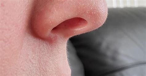 Skin Concerns Flesh Coloured Bump On Nose Imgur