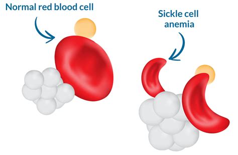 Sickle Cell Anemia