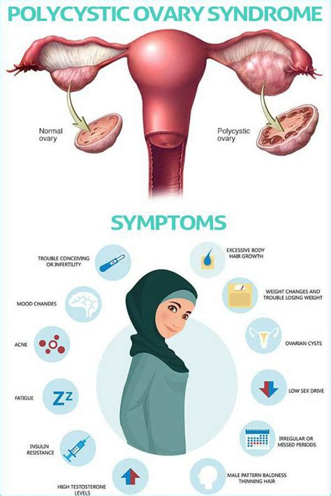PCOS MEDizzy