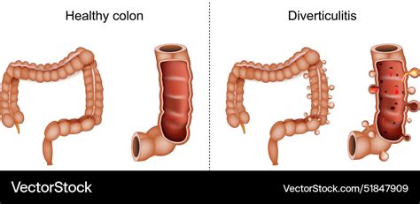 Diverticulitis Comparison And Difference Between Vector Image