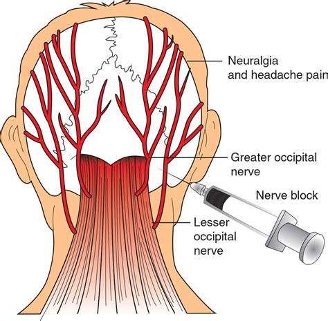 Health Meditation What To Know About Occipital Nerve Block