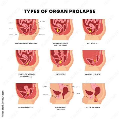 Photo Art Print Set Different Types Of Organ Prolapse Diagram Scheme
