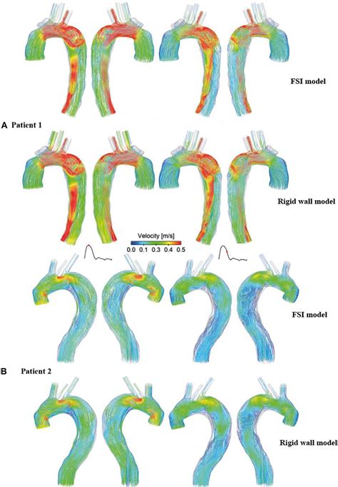 frontiers fluid structure interaction simulations of repaired type a aortic dissection a