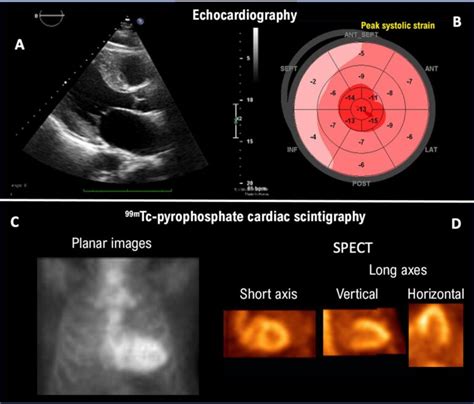 cardiac scintigraphy with bone markers in clinical practice when to solicit the exam how to