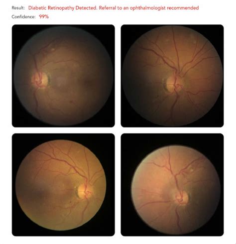 simple mobile based artificial intelligence algorithm in the detection of diabetic retinopathy