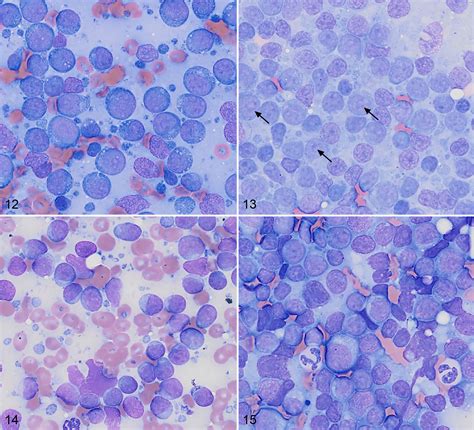 Diffuse Small B Cell Lymphoma A High Grade Malignancy Kelly L