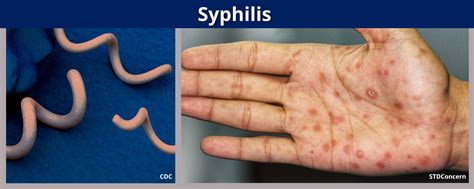 Syphilis Benton Franklin Health District
