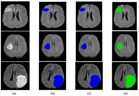 j imaging free full text brain tumor segmentation based on deep learning s feature